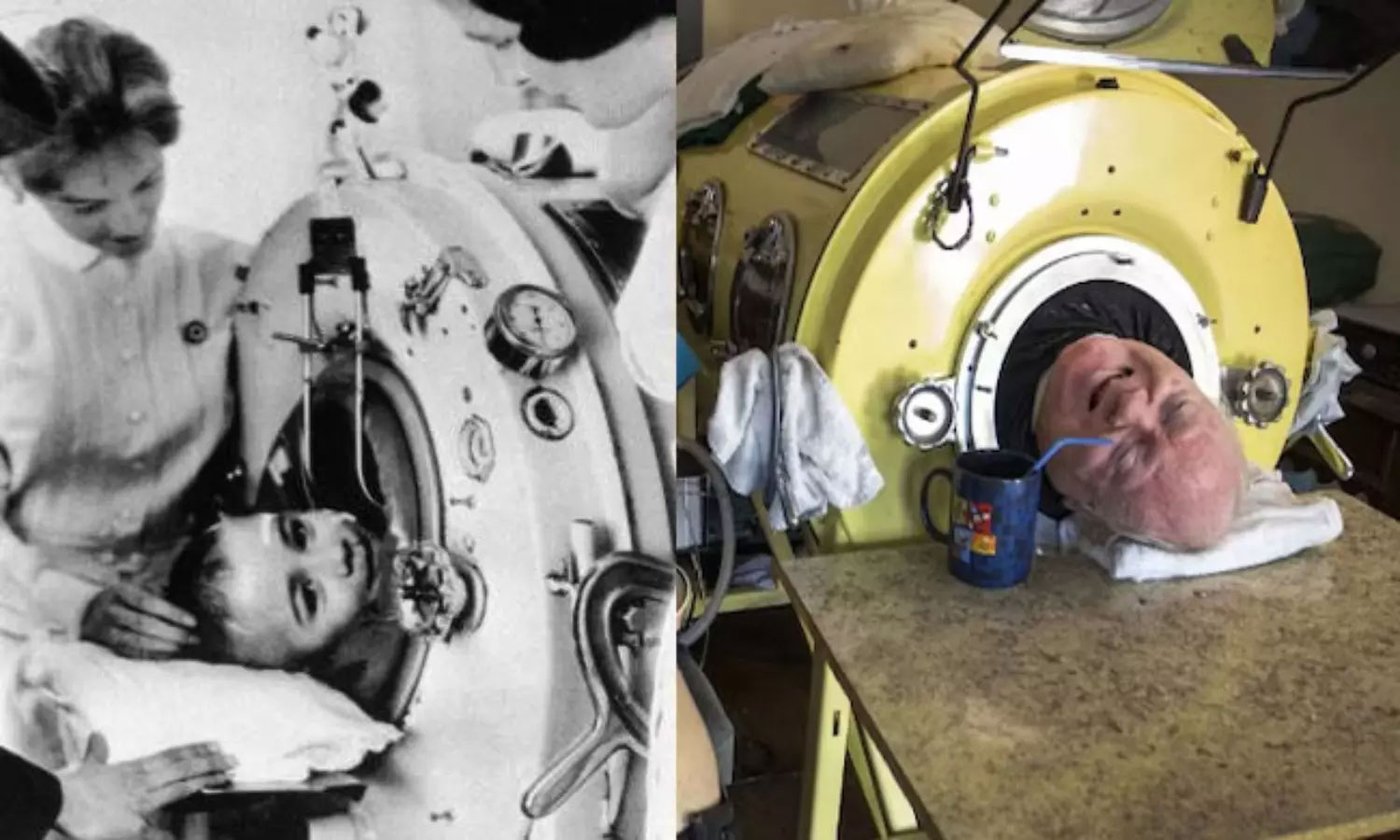 Paul Polio Who Lived In Iron Lung For 7 Decades Is No More! | Paul ...