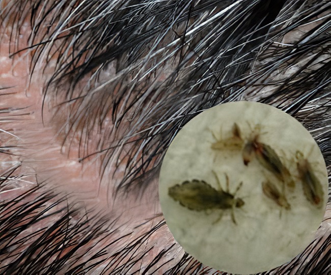 పేను కాటుతో వ్యక్తి మృతి